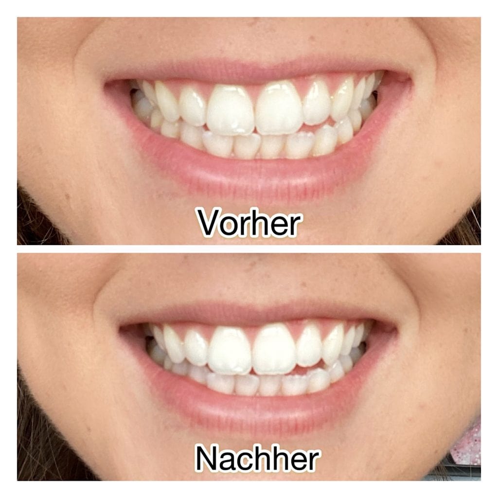 All Inclusive Zahnbleaching Set im Test | Apotheke.BLOG